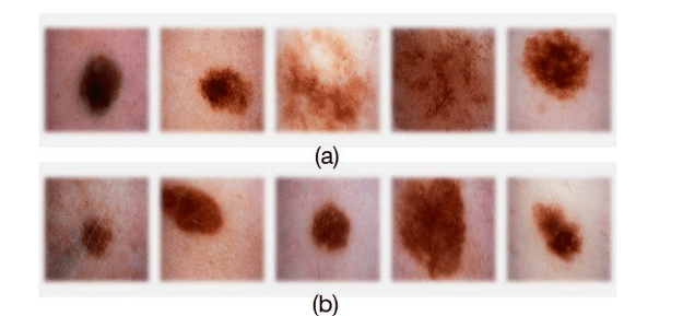 What Is Considered Early Detection Of Skin Cancer
